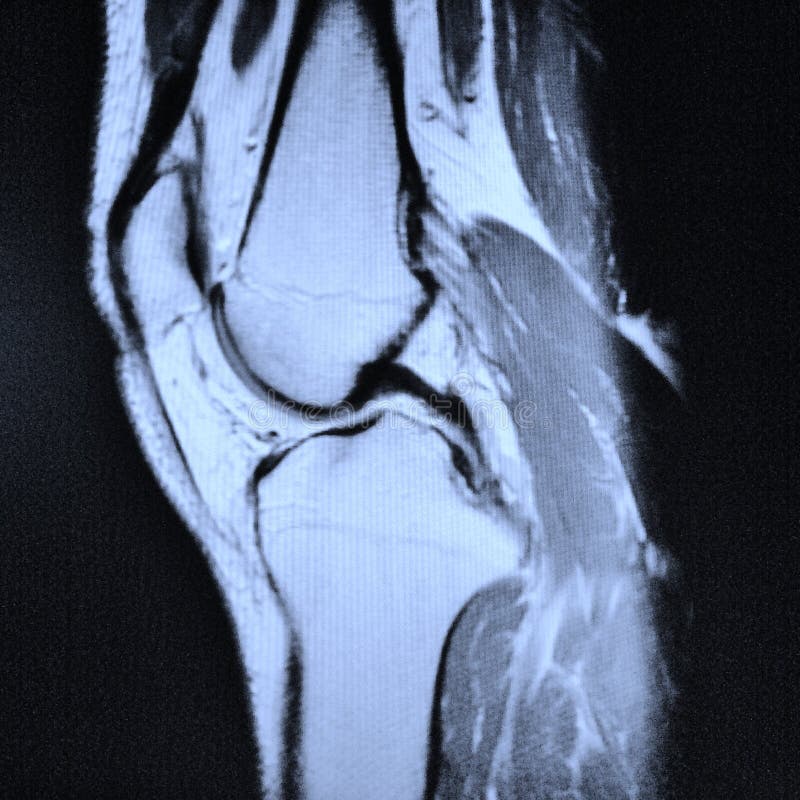 MRI Knie 2 stockfoto. Bild von zeigen, chirurgie, medizinisch - 2173276
