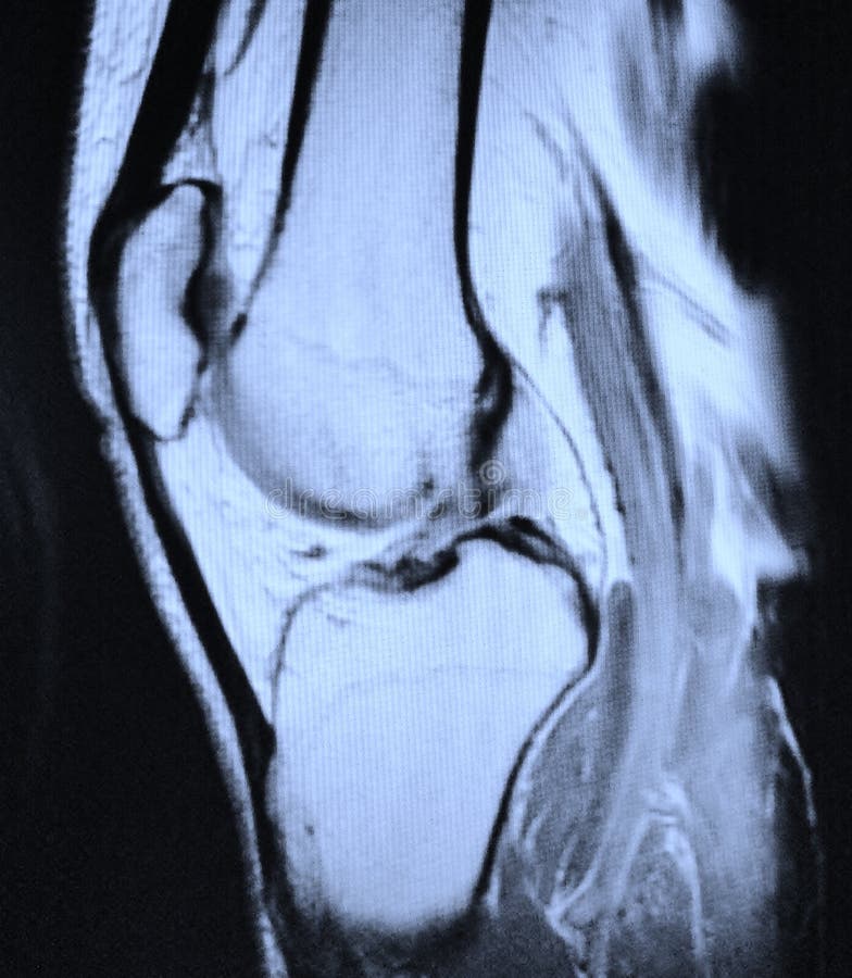 MRT des linken Knies stockfoto. Bild von strukturen, knie - 46287860