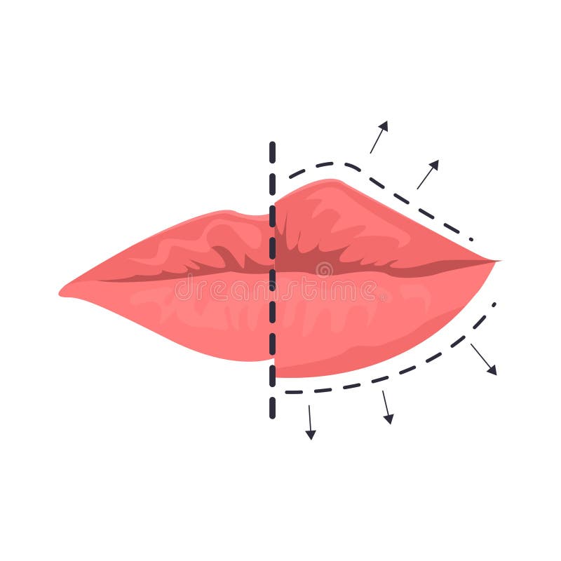 Lip Augmentation Illustration in Color Cartoon Style. Editable Vector ...