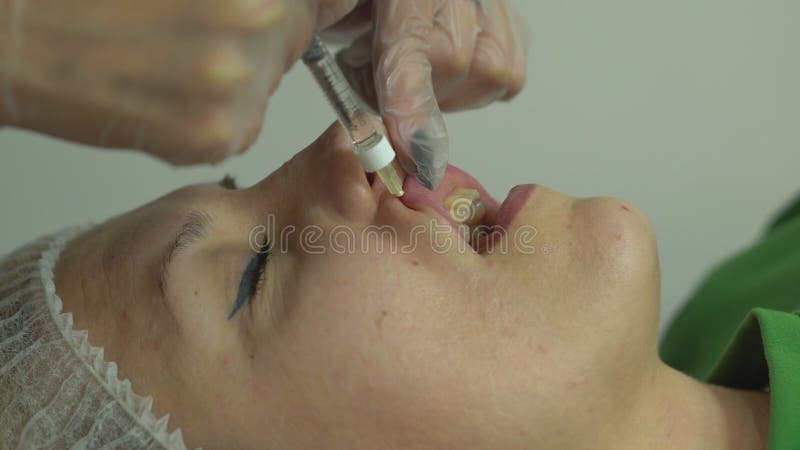 Lip Injection Procedure. Plastic Surgery. Stock Video - Video of ...