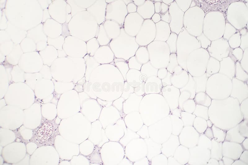 Lipoma, Benign Growth of Fatty Tissue Stock Photo - Image of adipose ...