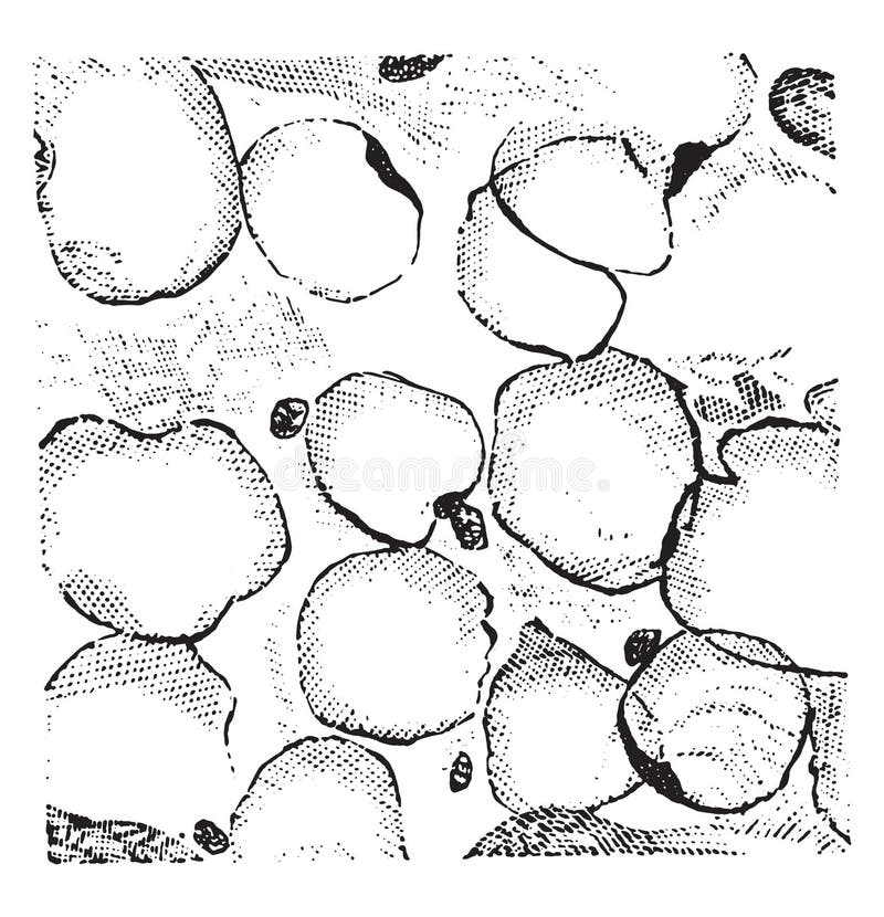 Lipoma, vintage engraving stock vector. Illustration of cell - 163073508