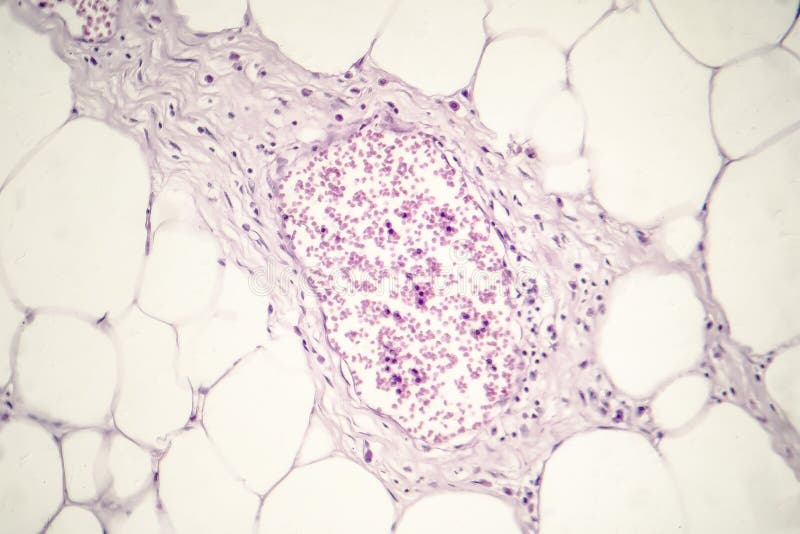 Lipoom, De Goedaardige Groei Van Vettig Weefsel Stock Afbeelding ...