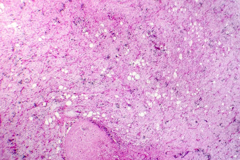 Liposarcoma, Soft Tissue Sarcoma Stock Photo - Image of photomicrograph ...