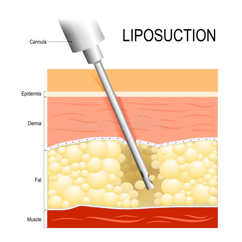 Liposuction. Cannula into the Fat Layer Beneath Skin. Stock Vector ...