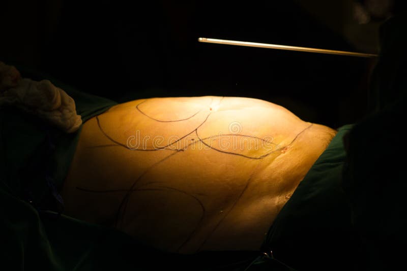 Liposuction Drawing Arrows Guideline Stock Photo - Image of concept ...