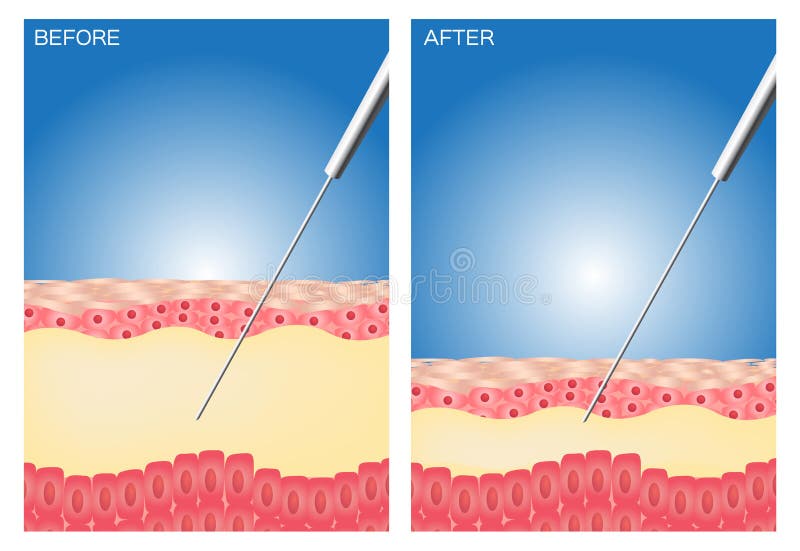 Leg Liposuction before and after , Fat , Diet , Surgery Stock Vector ...