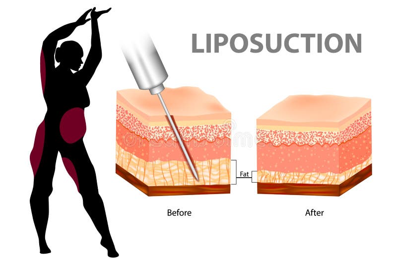 Liposuction or lipo. stock vector. Illustration of medicine - 119416362