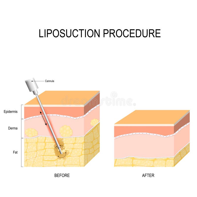 Liposuction. Cannula into the Fat Layer Beneath Skin. Stock Vector ...
