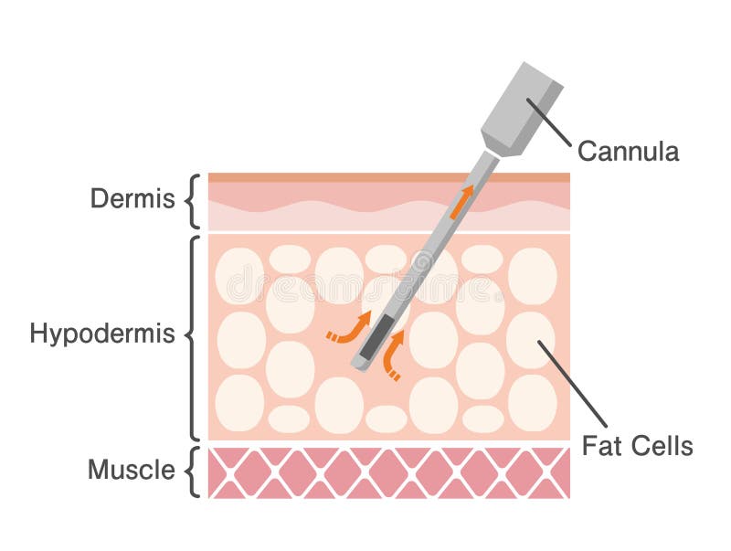 Liposuction Process Vector Illustration / Sectional View of Skin Stock ...