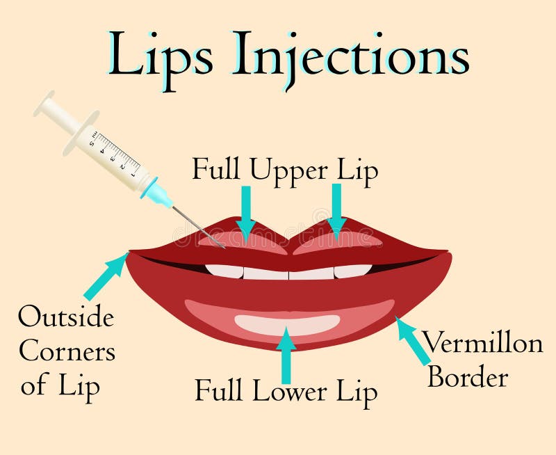 Lips Injection Vector Illustration Stock Vector - Illustration of mouth ...