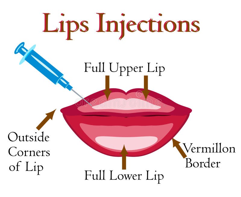 Lips Injection Vector Illustration Stock Vector - Illustration of ...