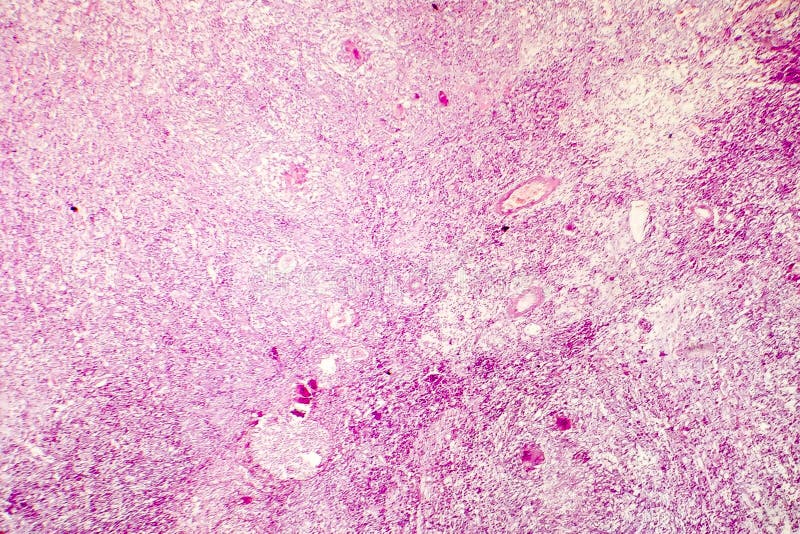 Liquefactive Nekrose Des Menschlichen Gehirns, Helles Fotomikrobild ...