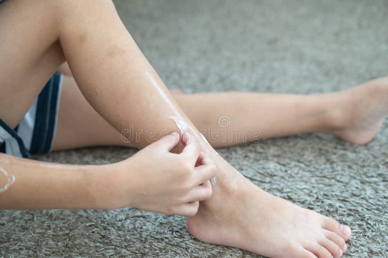 Little Asian Boy S Hands Peeling Off Dry Skin on His Legs. Skin ...