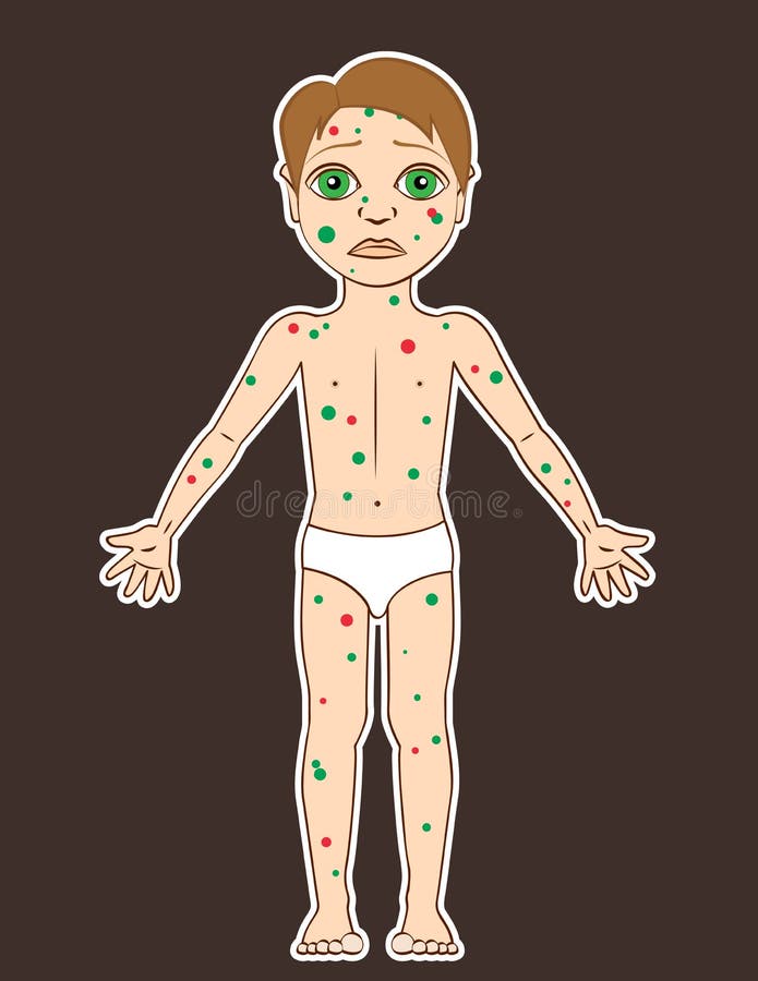 Little Boy hat Windpocken stock abbildung. Illustration von kopf - 38946500