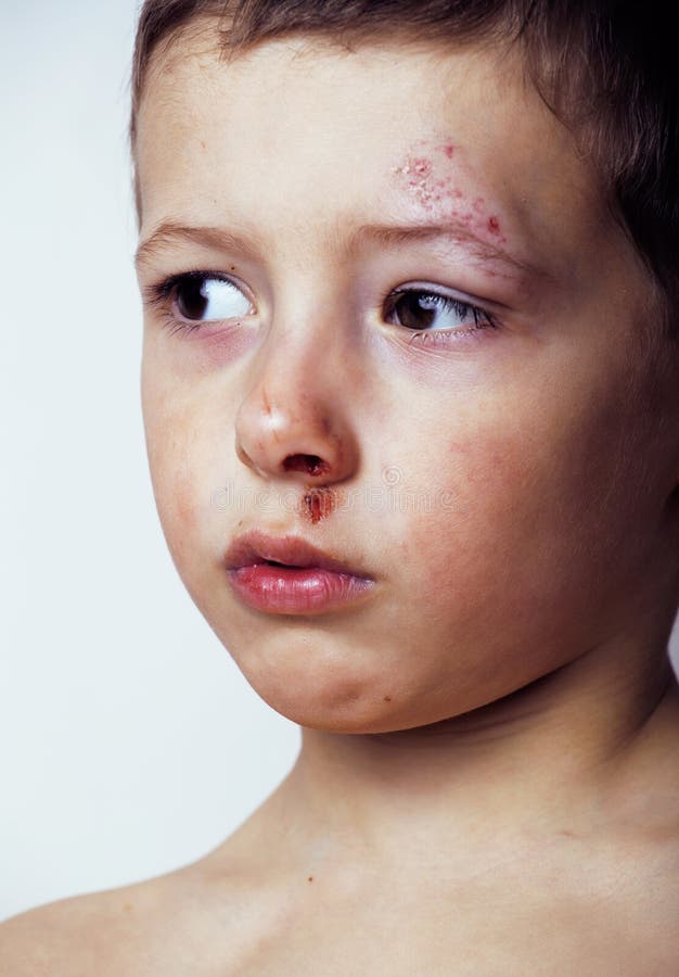 Bleed Forehead Girl Stock Photos - Free & Royalty-Free Stock Photos ...