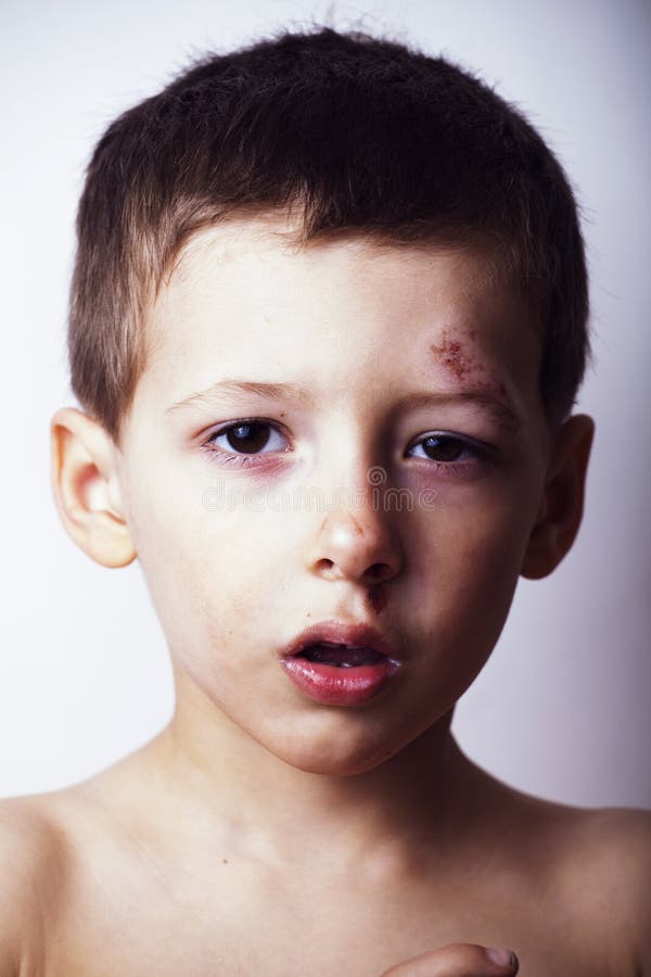 Little Boy Whipped Close Up, Isolated Stock Image - Image of illness ...