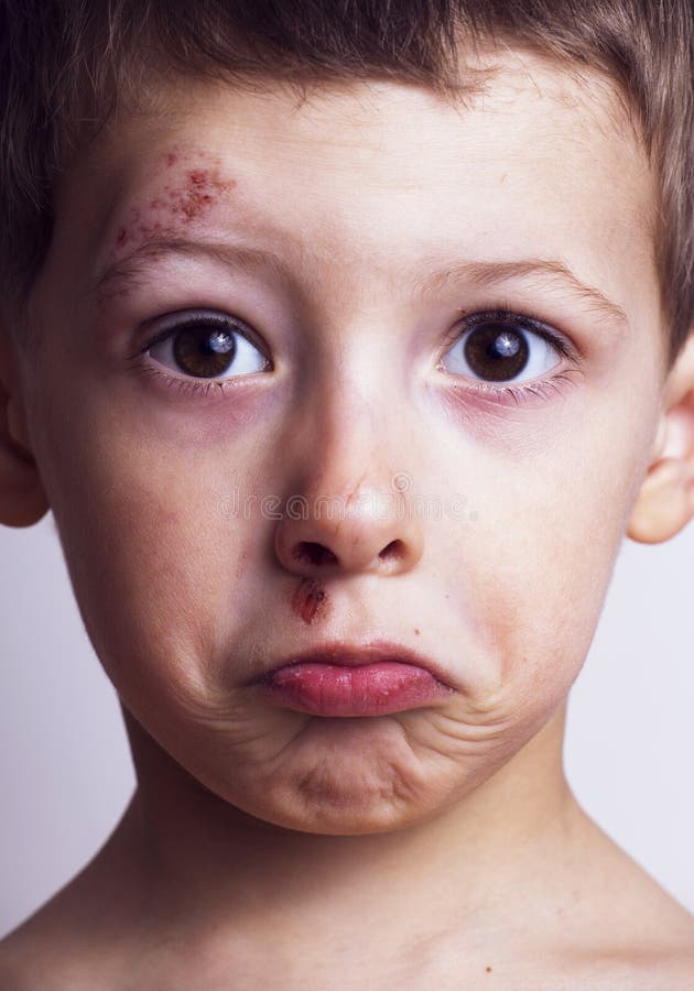 Little Boy Whipped Close Up, Isolated Stock Image - Image of injury ...