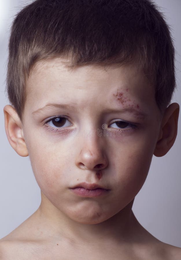 Bleed Forehead Boy Stock Photos - Free & Royalty-Free Stock Photos from ...