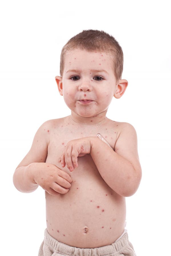 Smallpox stock image. Image of baby, body, pock, background - 51783789