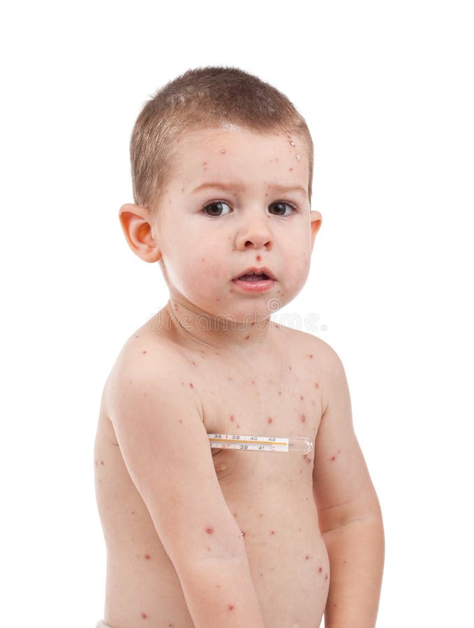 Little boy whit smallpox stock image. Image of smallpox - 18035891