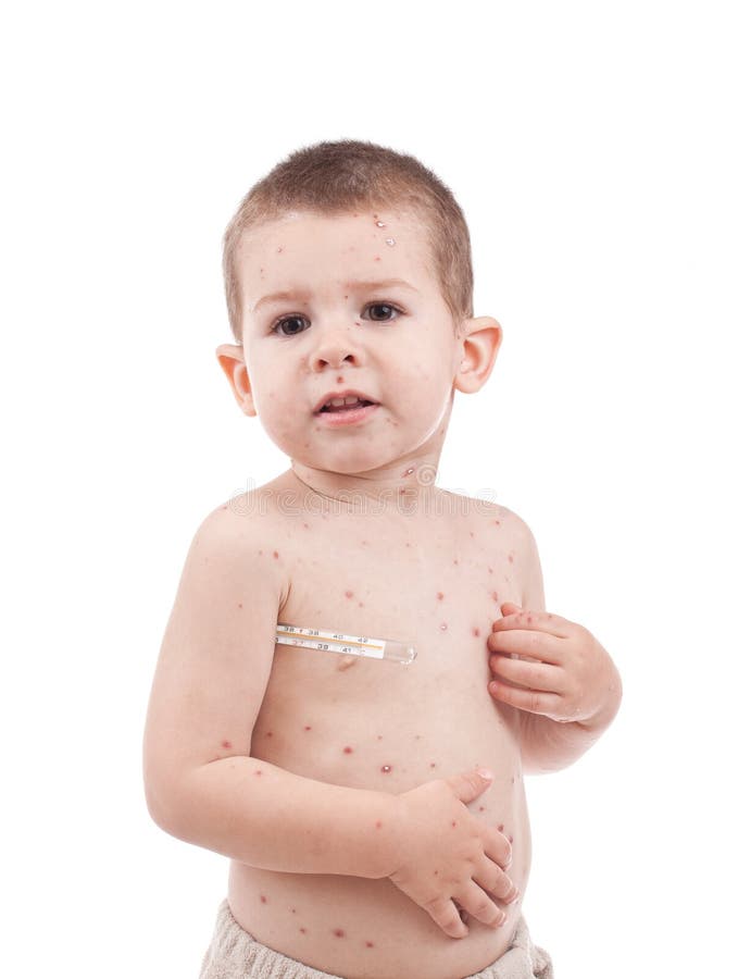 Chicken pox rash stock image. Image of protection, portrait - 25619011