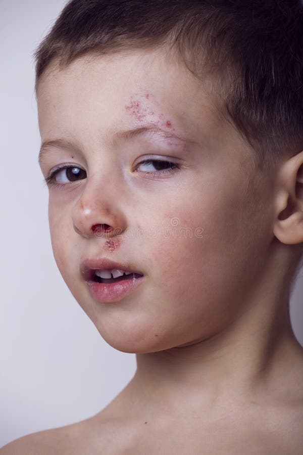 Little Boy with Wounded Face, Cockerel after Fight Stock Photo - Image ...
