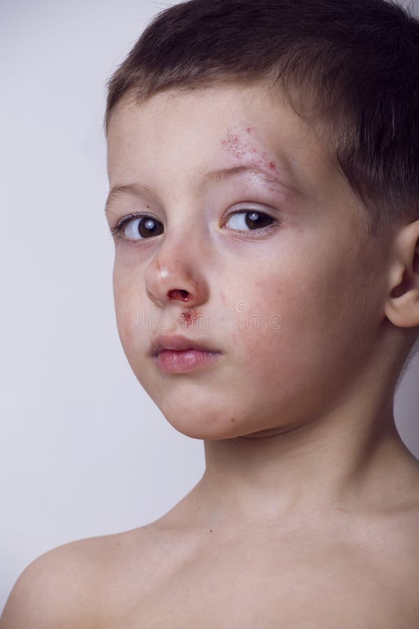 Little Boy with Wounded Face, Cockerel after Fight Stock Photo - Image ...