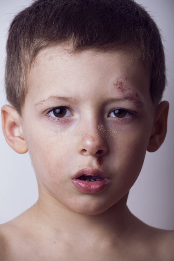 Little Boy with Wounded Face, Cockerel after Fight Stock Image - Image ...