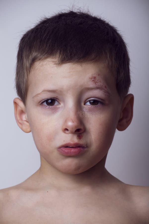 Little Boy with Wounded Face, Cockerel after Fight Stock Photo - Image ...