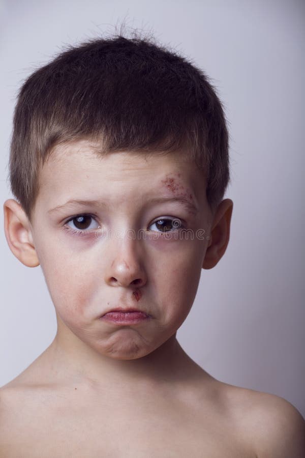 Little Boy with Wounded Face, Cockerel after Fight Stock Photo - Image ...