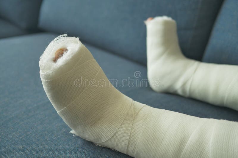 Little Child with Plaster Bandage on Leg. Stock Photo - Image of human ...