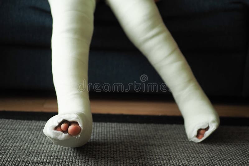 Little Child with Plaster Bandage on Leg. Stock Photo - Image of ...