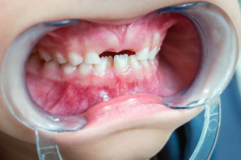 Little Child`s Broken Teeth Stock Image - Image of pathology, human ...