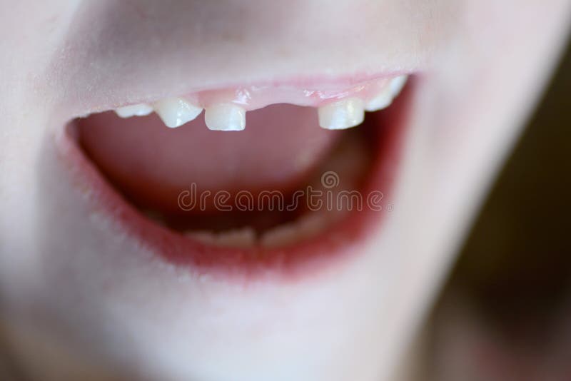 Little Child Smiling Missing Front Tooth Stock Image - Image of face ...