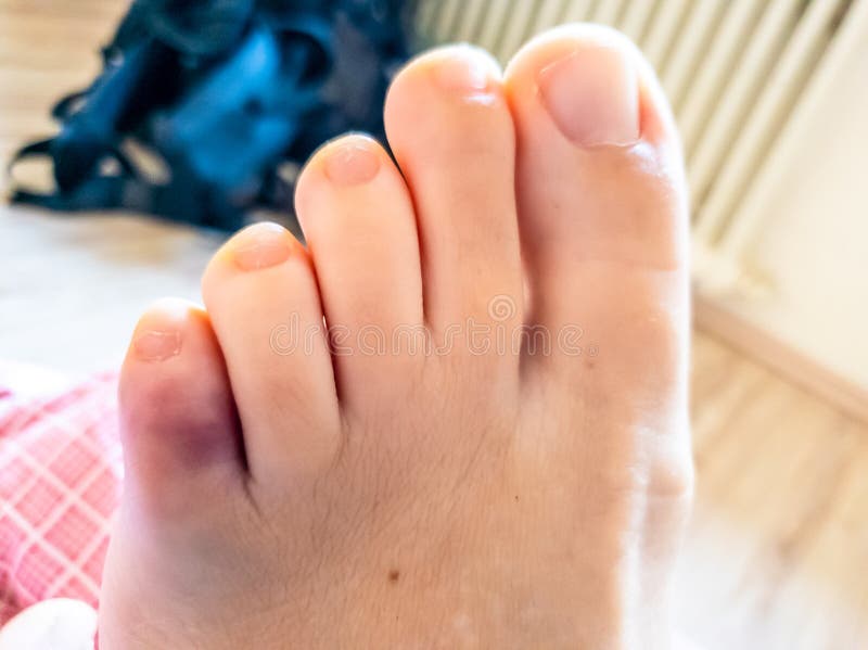 Little Toe Broken Getting Coloured Blue and Purple. Stock Image - Image ...