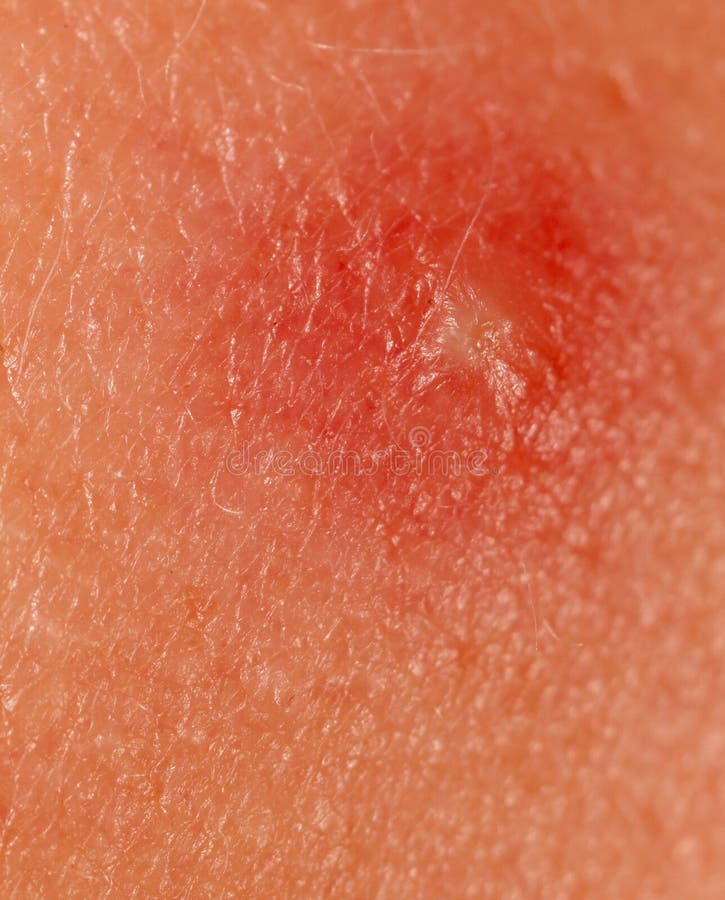 Little wound on human skin stock image. Image of injury - 171300095