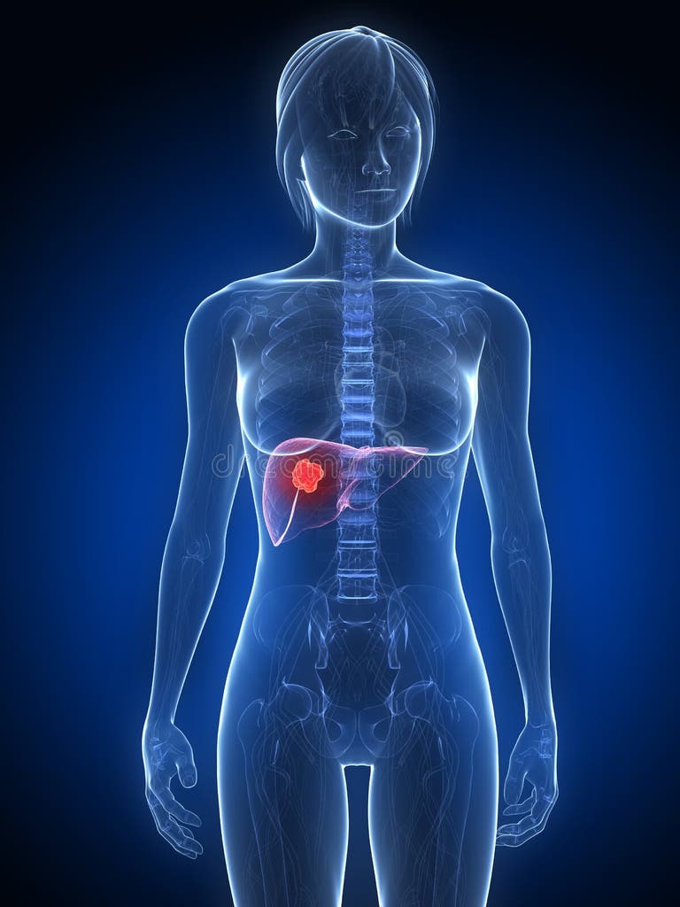 Liver Cancer Anatomy Stock Illustrations 5252 Liver Cancer Anatomy Stock Illustrations