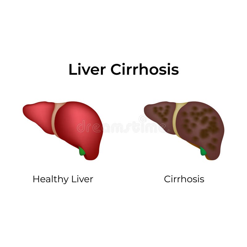 Liver Cirrhosis Healthy Vs Diseased Liver Stock Vector - Illustration ...