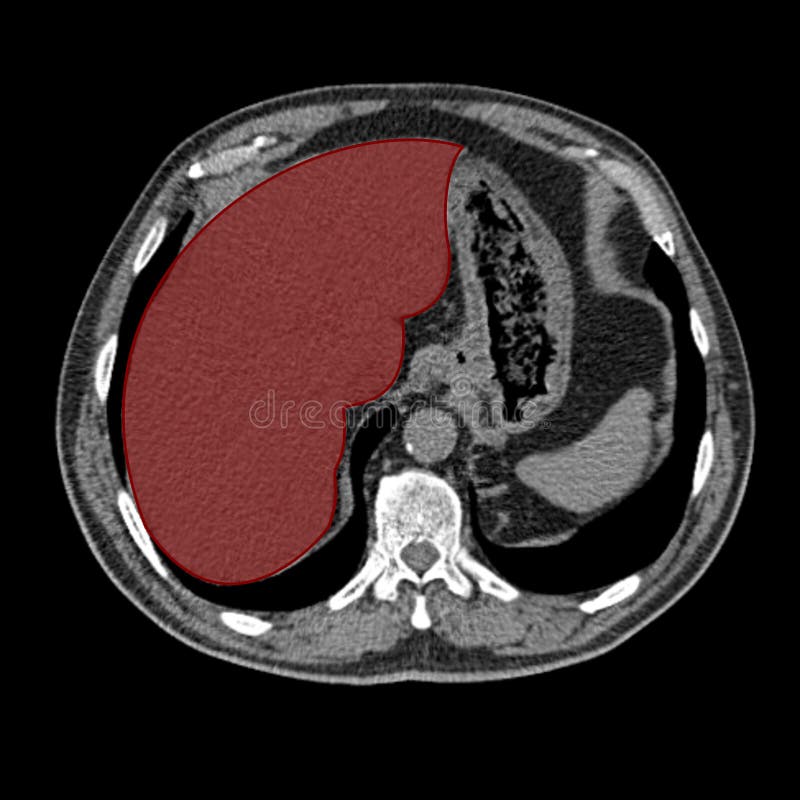 Liver on Computed Tomography Stock Image - Image of scan, abdominal ...