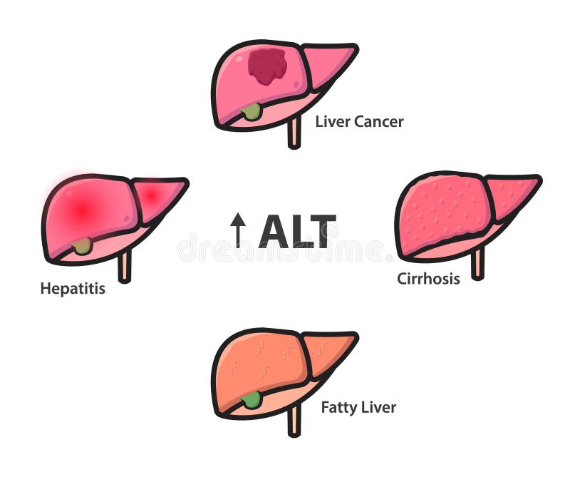 Liver Conditions Common Causes of the High Level of ALT in a Blood ...