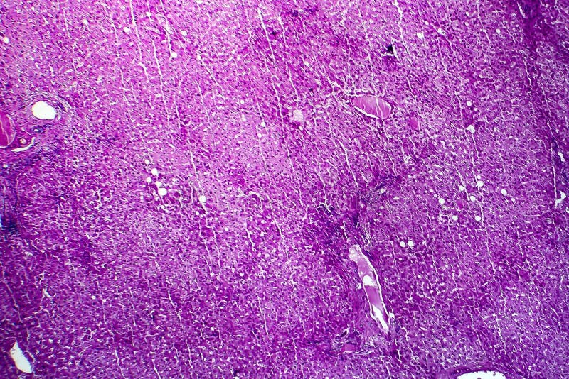 Liver Edema, Light Micrograph Stock Photo - Image of edema ...