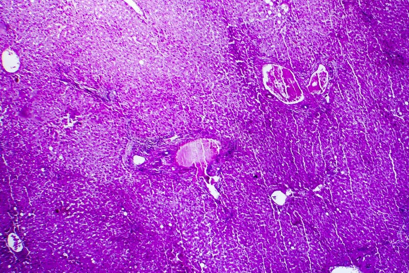 Liver Edema, Light Micrograph Stock Photo - Image of stain, medical ...