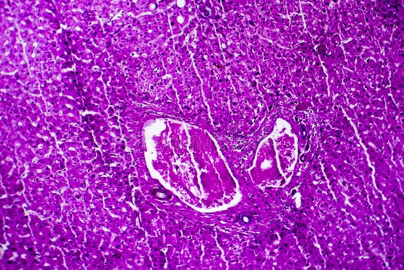 Liver Edema, Light Micrograph Stock Photo - Image of stain, medical ...