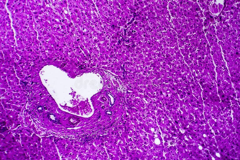 Liver Edema, Light Micrograph Stock Photo - Image of microscopic ...