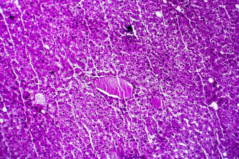 Liver Edema, Light Micrograph Stock Image - Image of hepatic, pathology ...