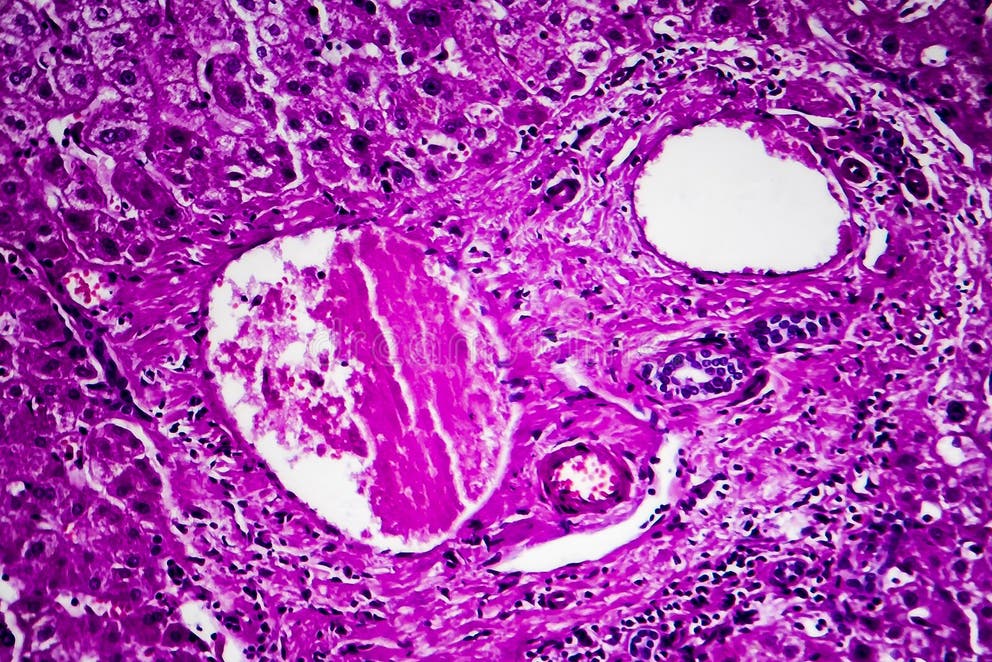 Liver Edema, Light Micrograph Stock Image - Image of hepatobiliary ...