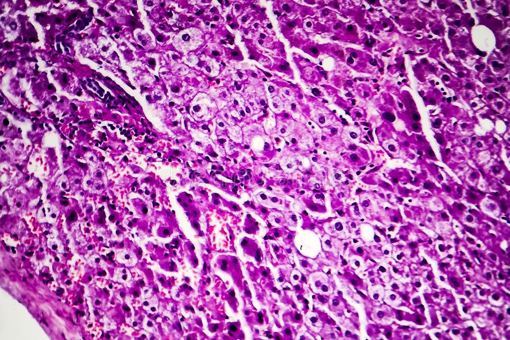 Liver Edema, Light Micrograph Stock Image - Image of morphological ...