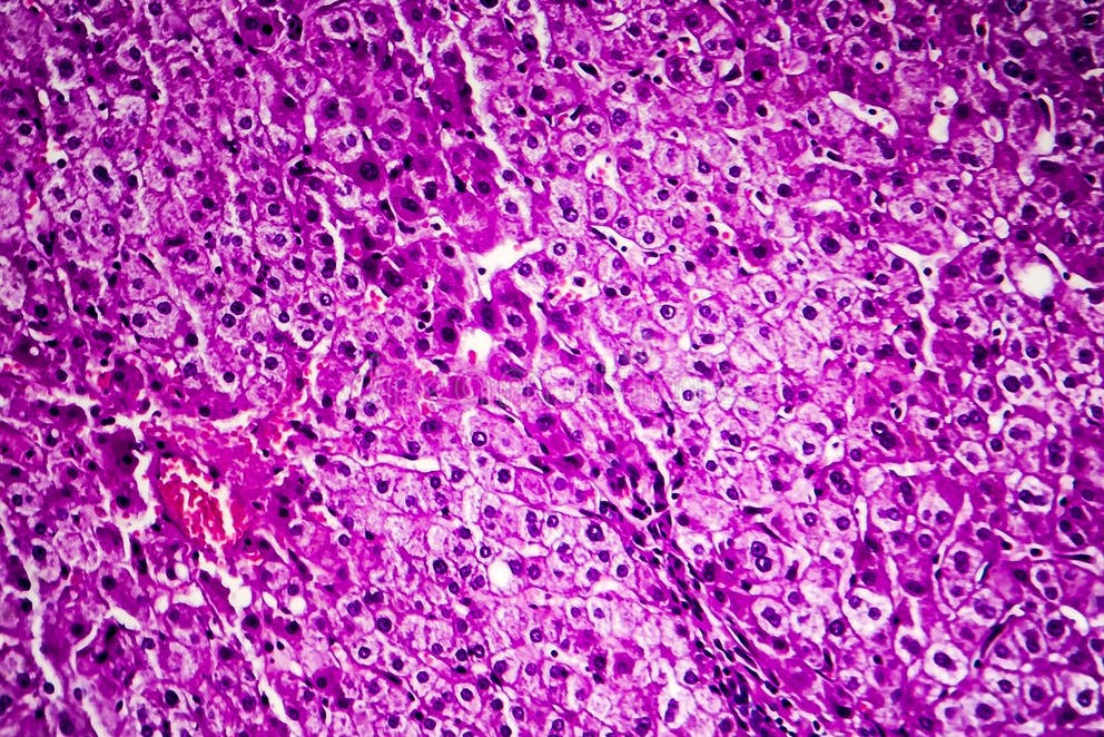 Liver Edema, Light Micrograph Stock Image - Image of hematoxylin ...