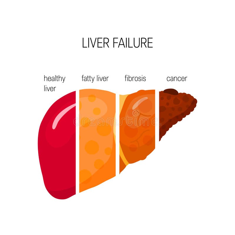 Liver Failure Stock Illustrations – 1,118 Liver Failure Stock ...